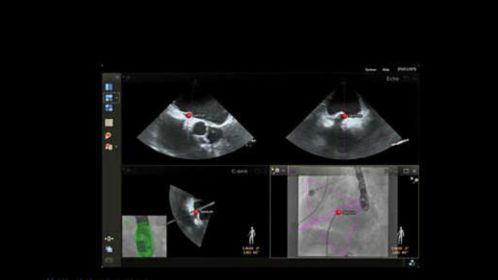 EchoNavigator | Philips