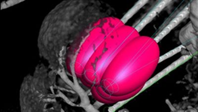 Philips - XperGuide ablation