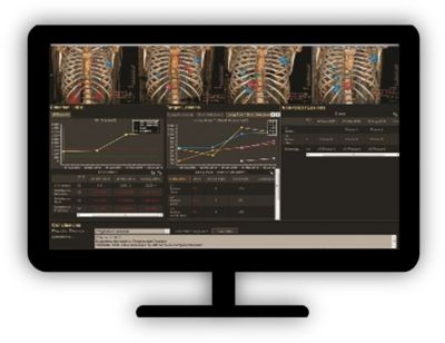 Philips - Multi Modality Tumor Tracking (MMTT)