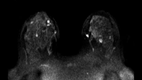 Diffusion Breast MR clinical application | Philips Healthcare