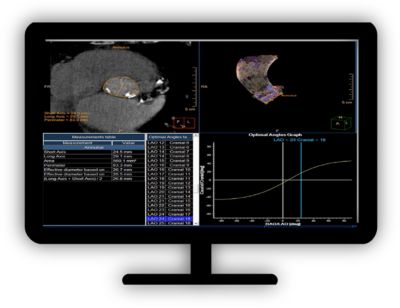 Philips - CT TAVI Planning