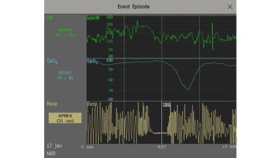 Neonatal Event Review | Philips