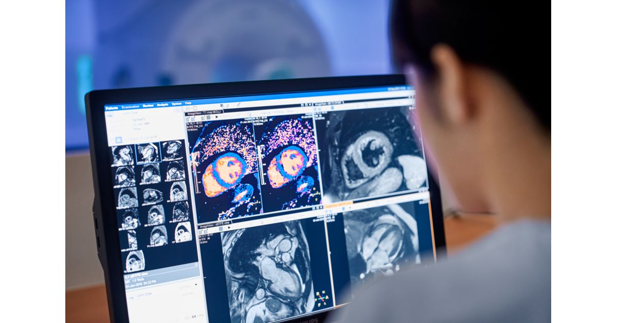 Compressed SENSE clinical cardiac MRI - Philips