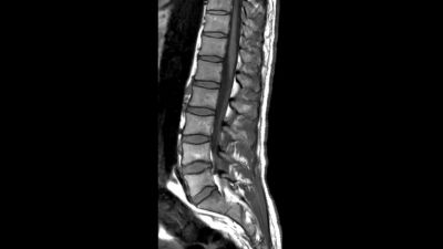 Philips - SmartSpeed - Spine HCNMRF445A MR Clinical Applications