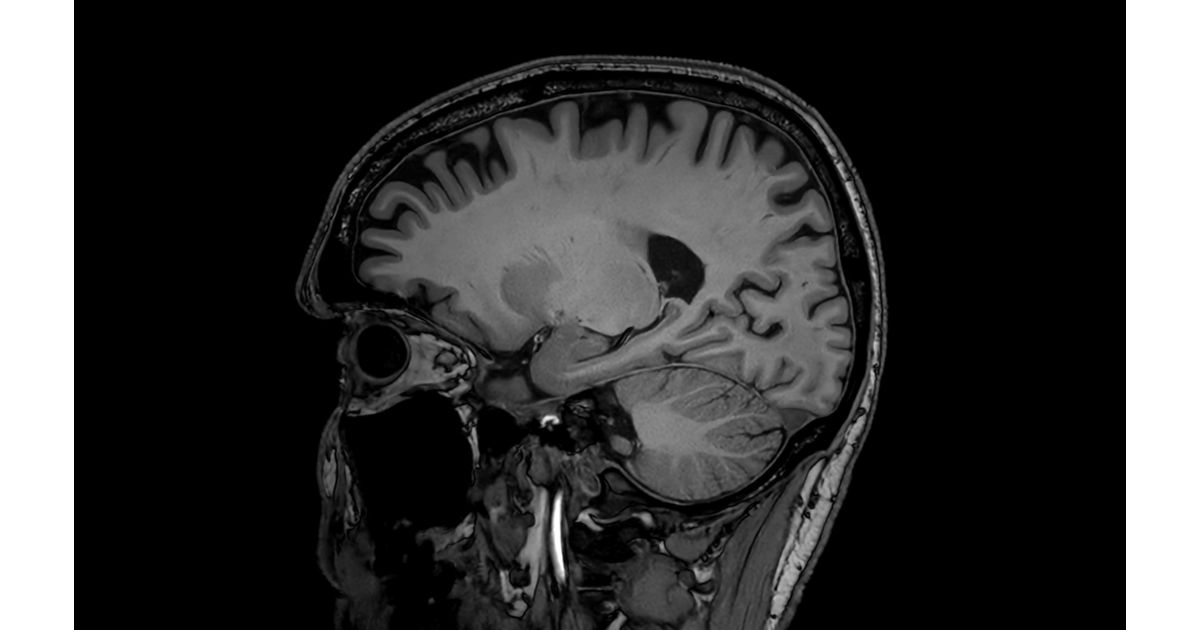 Alzheimer’s disease MR imaging - Philips