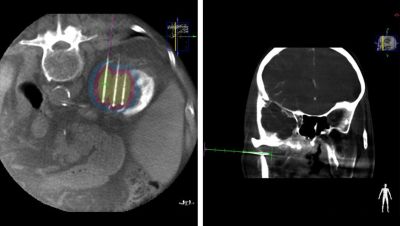 Philips - XperGuide Live 3D needle guidance