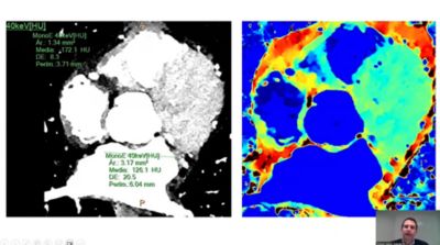 Spectral CT One-Stop Shop - Philips