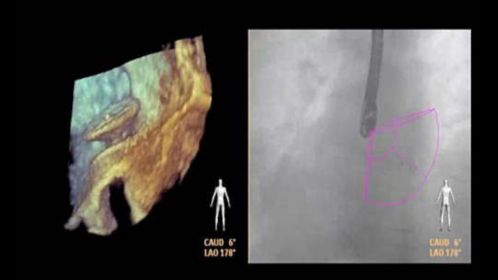 EchoNavigator | Philips