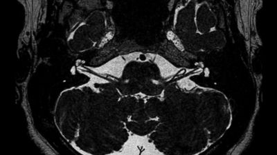 3D DRIVE MR Clinical application | Philips