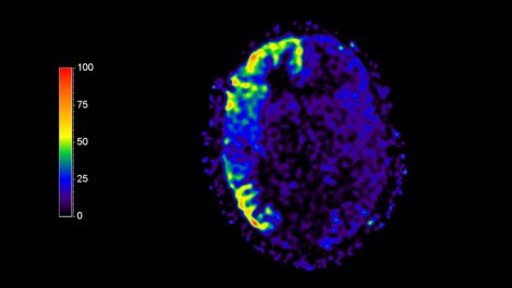 3D ASL MR clinical application | Philips Healthcare