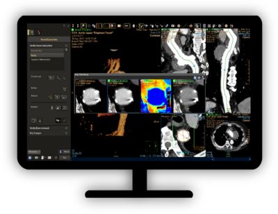 Philips - CT Spectral Advanced Vessel Analysis
