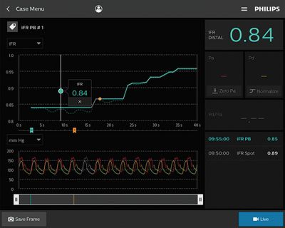 Coronary physiology modalities - Philips