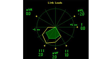Philips - ST Map Graphical display of ST segment data