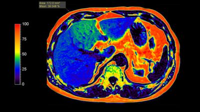 Philips - mDIXON Quant MR clinical application