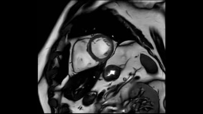 Philips – SmartSpeed Cardiac HCNMRF450, applications cliniques IRM