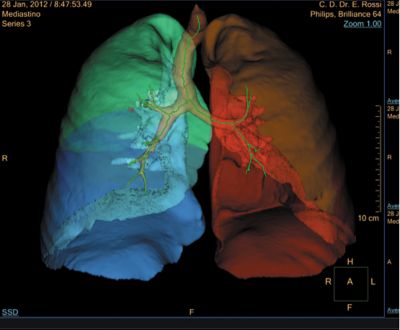 CT COPD | Philips