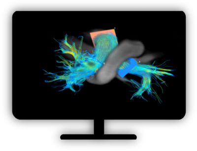 Philips - MR Caas 4D flow
