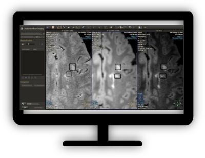 Philips - MR Longitudinal Brain Analysis (LOBI)