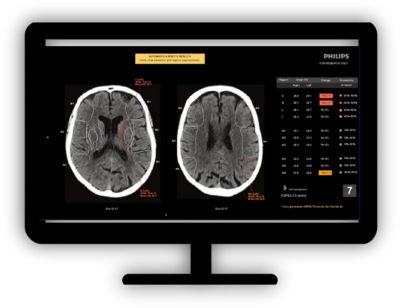 Philips - CT ASPECT Scoring