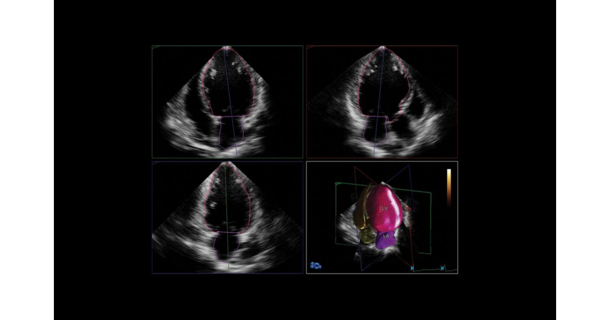 HeartModel clinical study - Philips
