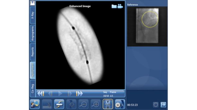 Philips Volcano - SyncVision Precision guidance system