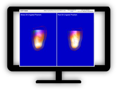 Philips - NM Emory Cardiac Toolbox (ECTb) HeartFusion