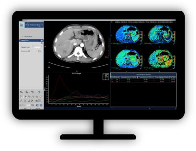 Philips - CT Body Perfusion Quantifiable perfusion