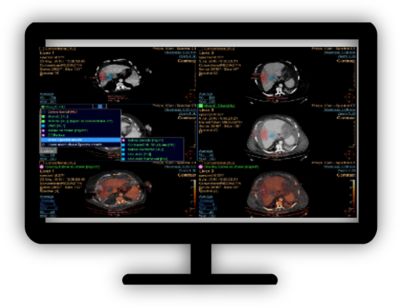 Philips - CT Spectral Tumor Tracking