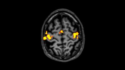 Philips - BOLD MR Clinical application