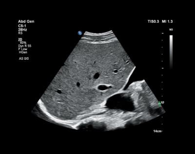 Liver Ultrasound Products Services Philips