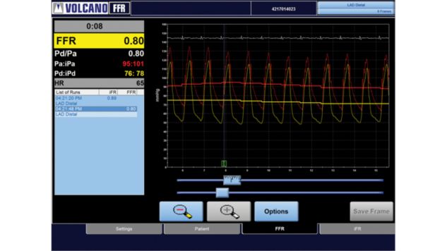 Philips Volcano - Core Mobile Precision guided therapy system