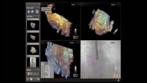 EchoNavigator | Philips