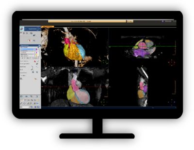 Philips - MR Cardiac Whole Heart