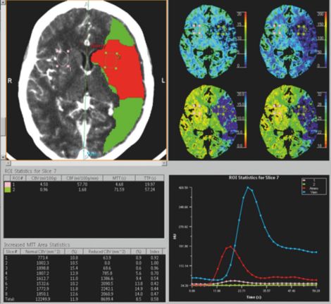 CT Brain Perfusion | Philips