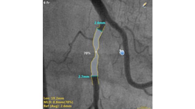 Philips Volcano - SyncVision Precision guidance system