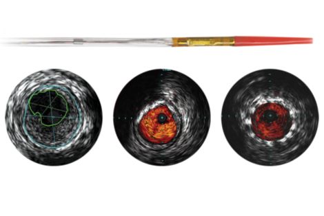 Visions PV .014P RX Digital IVUS catheter | Philips Healthcare
