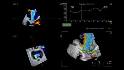 3D Auto Color Flow Quantification - Philips