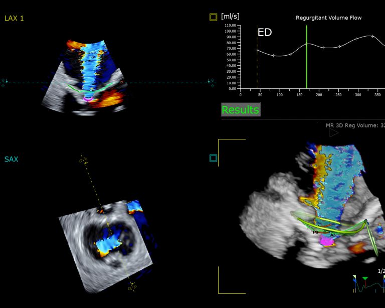 Ultrasound transducers - Philips