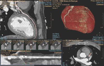 CT Comprehensive Cardiac Analysis (CCA) | Philips