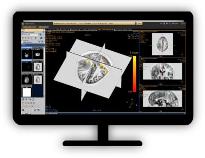 Philips - MR Brain Function Analysis Brain activation analysis