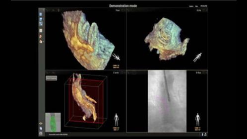 EchoNavigator | Philips