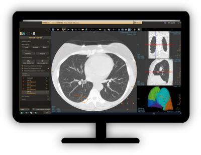 Philips - CT Lung Nodule CAD