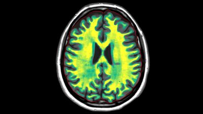 Philips - 3D Smart Quant Neuro NMRF583 MR Clinical Applications