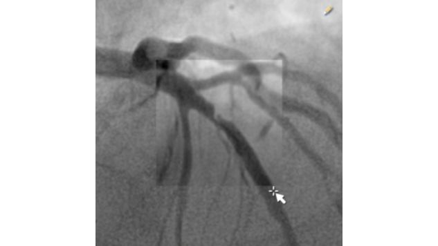 Philips Volcano - SyncVision Precision guidance system