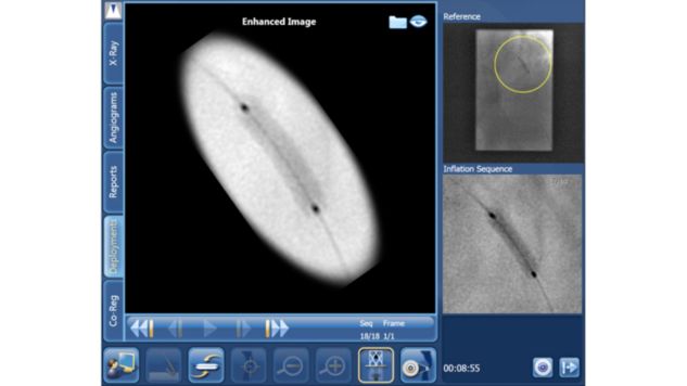 Philips Volcano - SyncVision Precision guidance system