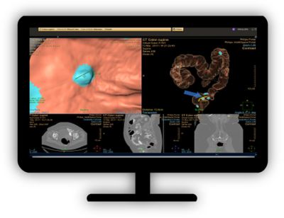 Philips - CT Virtual Colonoscopy Veralook CAD